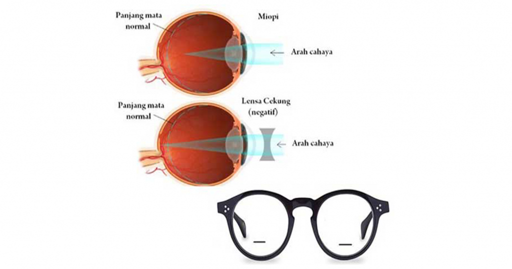 Mata merupakan Jendela Dunia: Gangguan Pada Mata